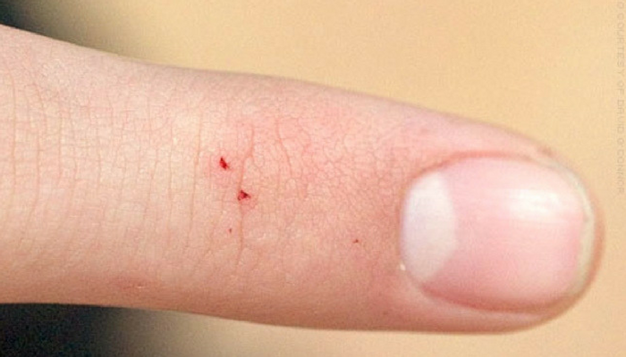 Punture ragno | Momentobenessere